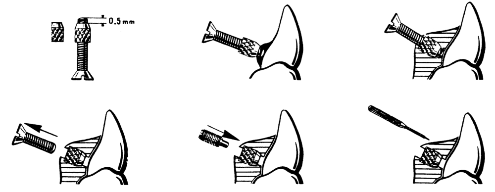 Piston spring screws, set - DENTAURUM USA eShop